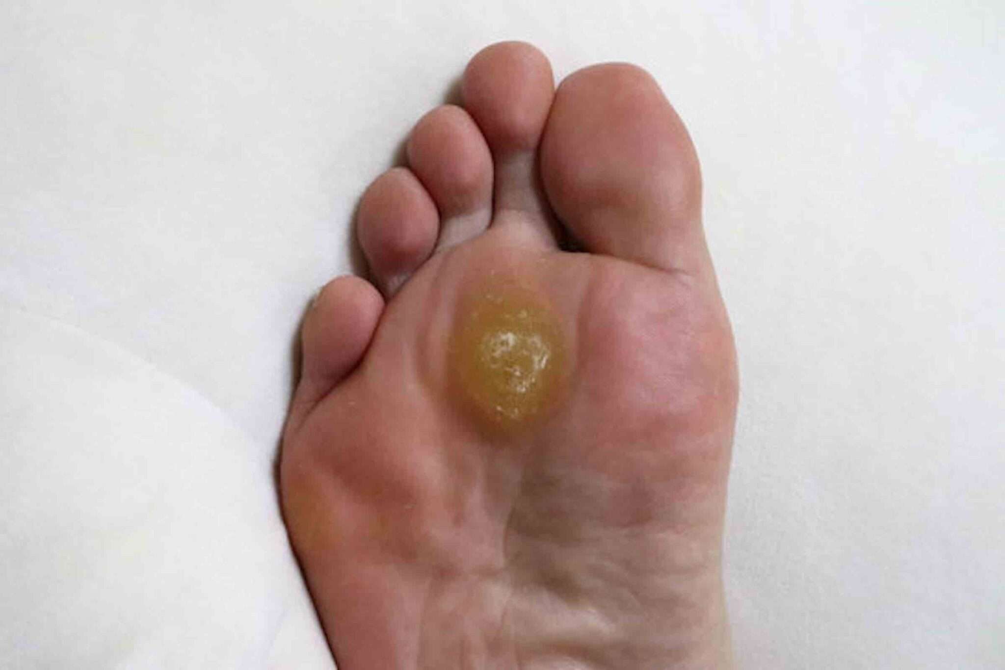 Foot Corns and Callus | Leading Health Podiatry