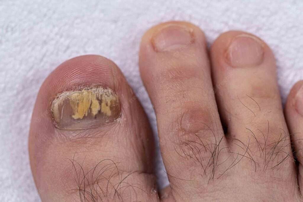 Fungal Nail infection Treatment Adelaide | Leading Health Podiatry.