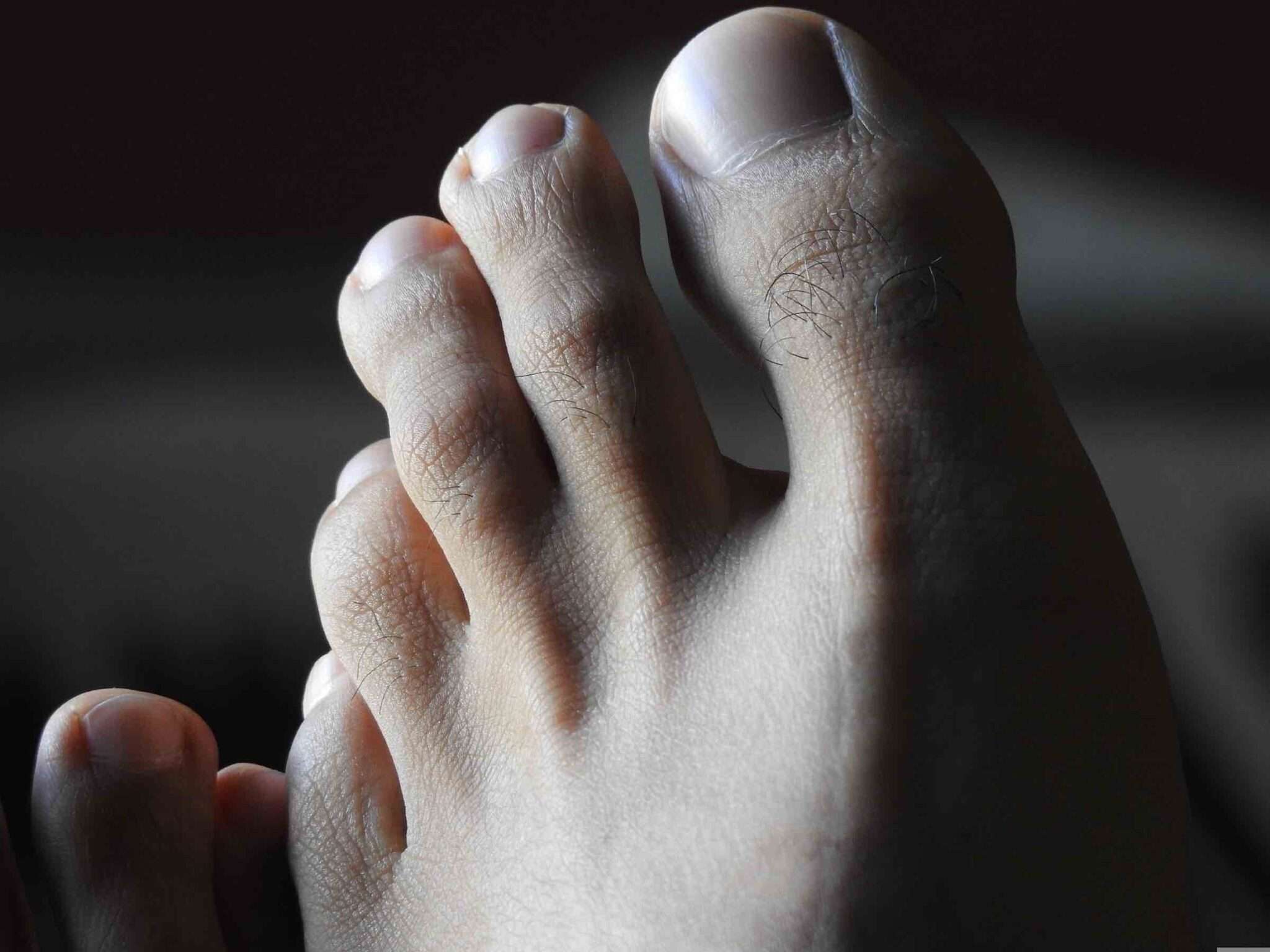 Hammer Toes Treatment | Leading Health Podiatry