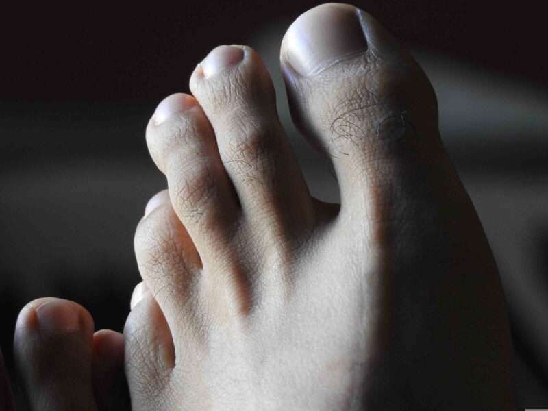 Hammer Toes Treatment | Leading Health Podiatry