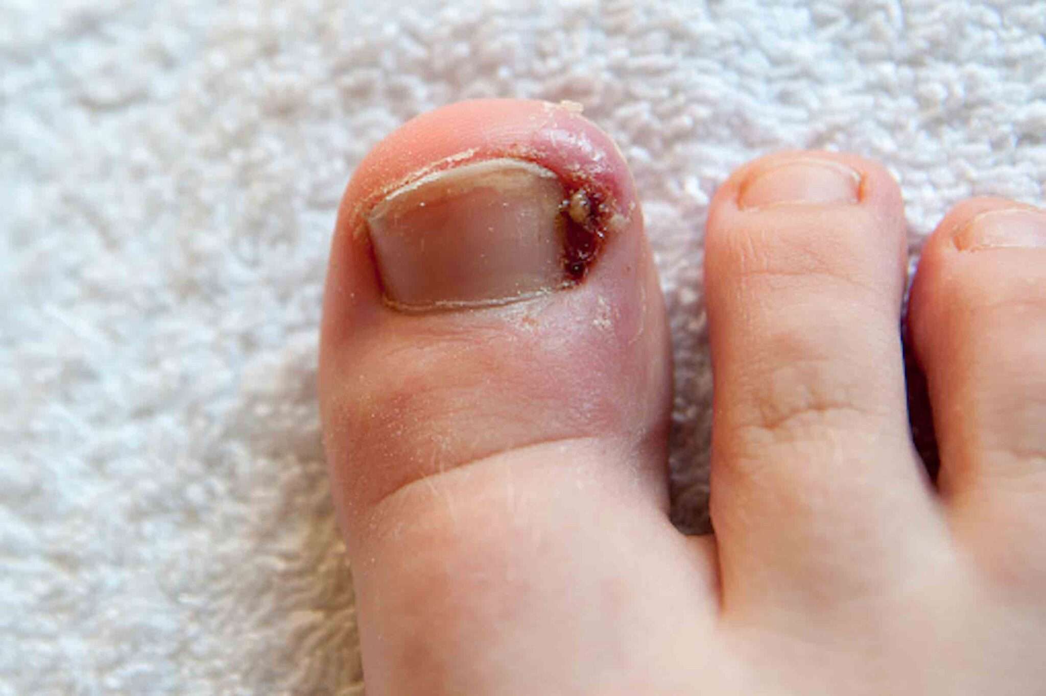 Our Highly Trained Podiatrist Can Perform Ingrown Toenail Surgery ...