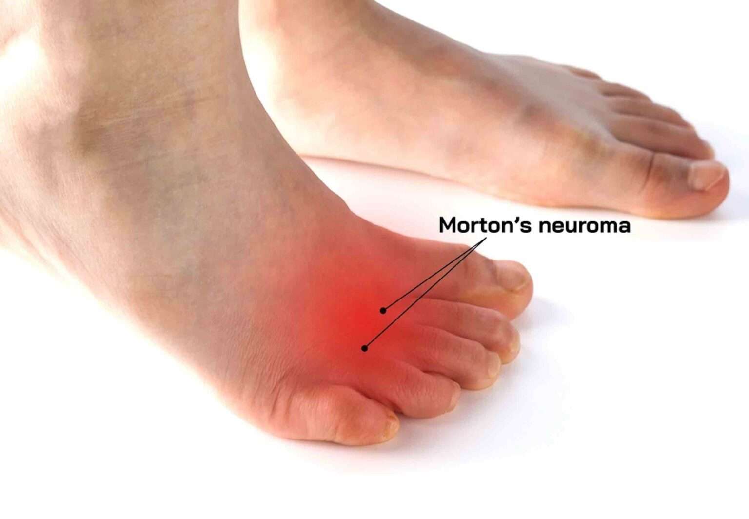 Metatarsalgia Causes & Treatment | Leading Health Podiatry