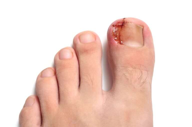 How To Fix Ingrown Toenail Permanently – Fix It Once and For All!