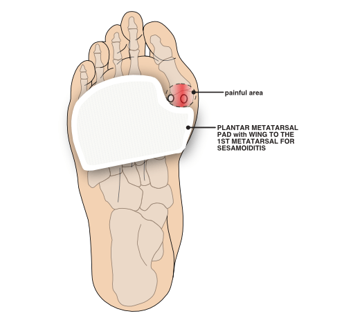 Sesamoiditis Causes & Treatment | Leading Health Podiatry