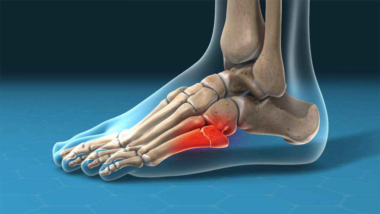 Styloid Process Avulsion Fracture | Leading Health Podiatry