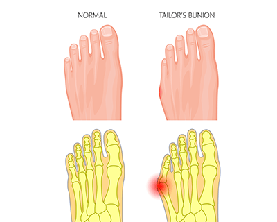 Tailor’s Bunion Causes & Treatment | Leading Health Podiatry