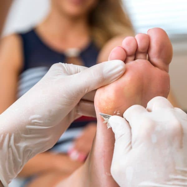 How to Remove Callus From Feet Best Home & Podiatry Treatment