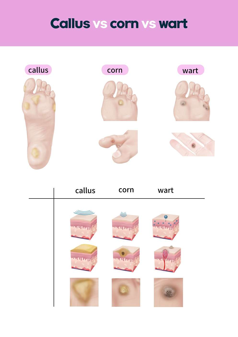 How to Remove Callus From Feet Best Home & Podiatry Treatment